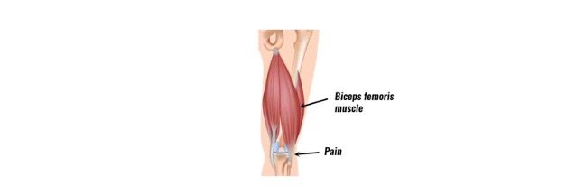 Biceps Femoris: Functions, Location, and Structure